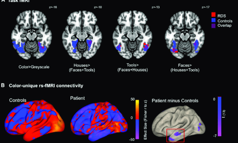 fmri چیست:یک روش تصویربرداری قدرتمند برای درک ذهن انسان