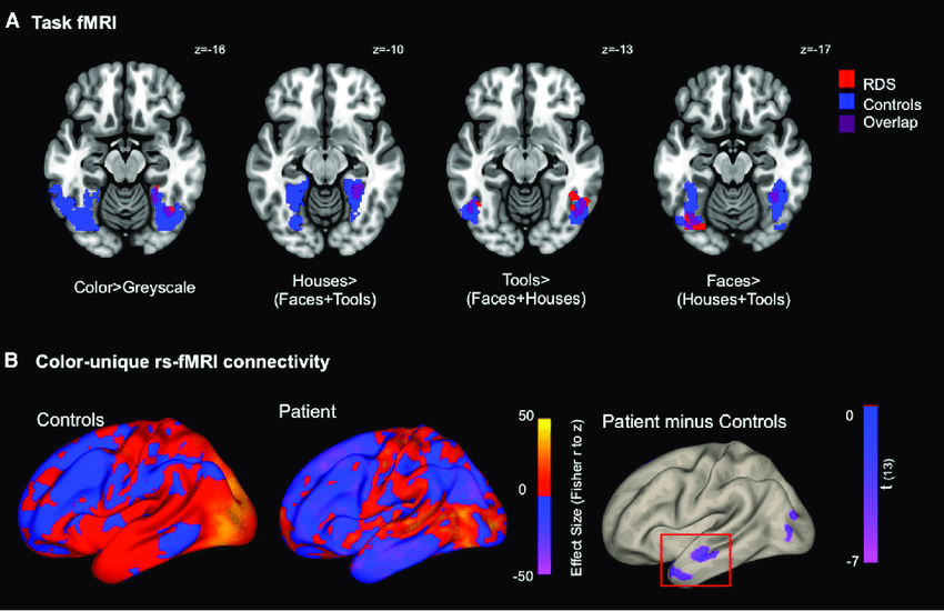 fmri چیست:یک روش تصویربرداری قدرتمند برای درک ذهن انسان